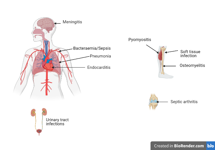 GBS Diseases and Clinical Presentation | maidenlab